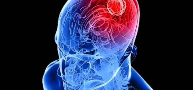 Conoce todo sobre el ictus y como tratarlo